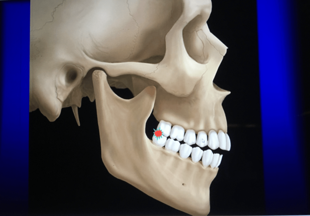 TMD Treatment | Knight Orthodontics | Louisville Orthodontics